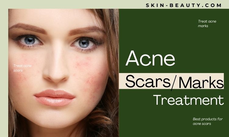 Acne Scars vs. Acne Marks Treatments – Skin Beauty Blog